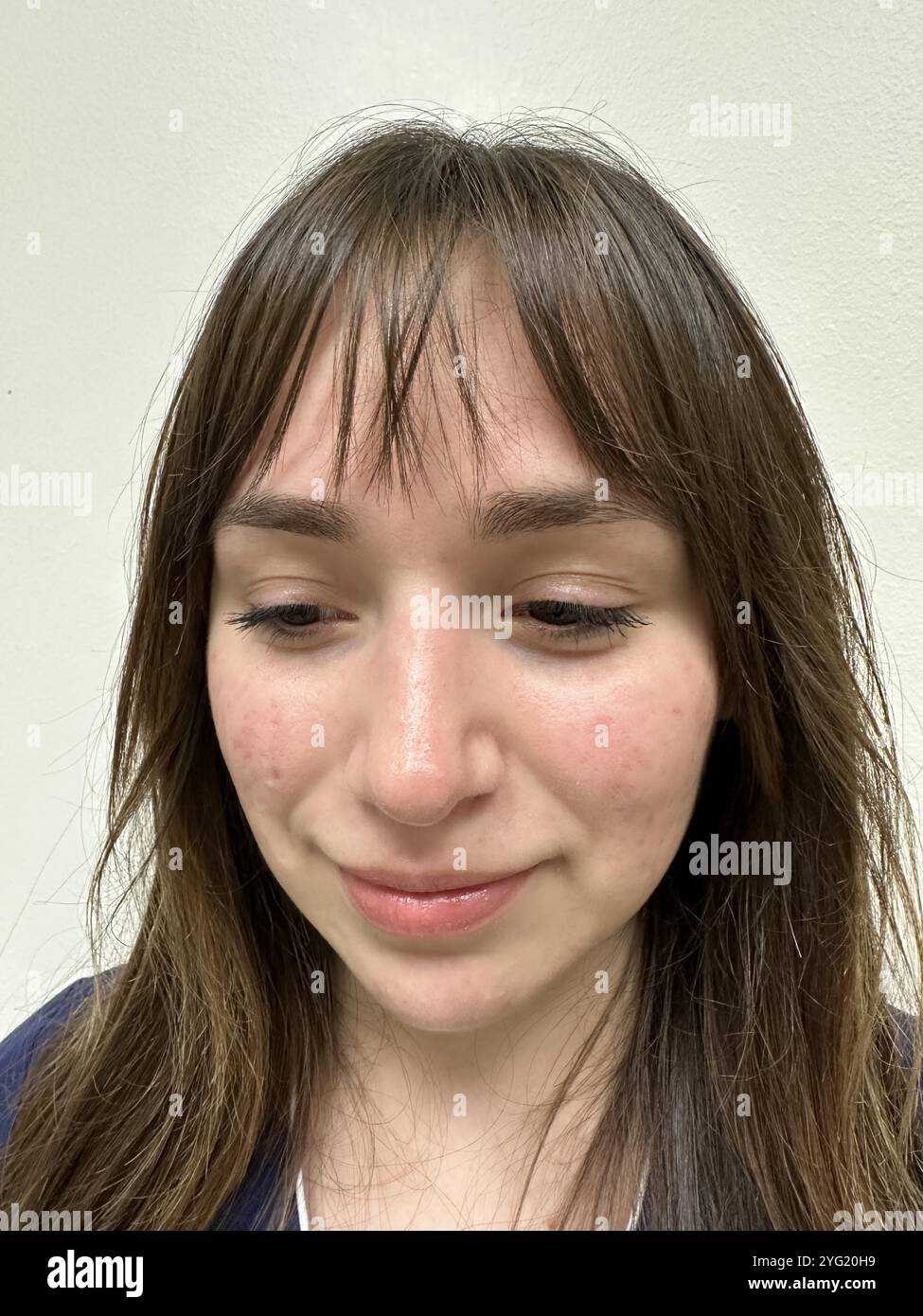 Editorial use only Face of female patient whose acne is improving due ...