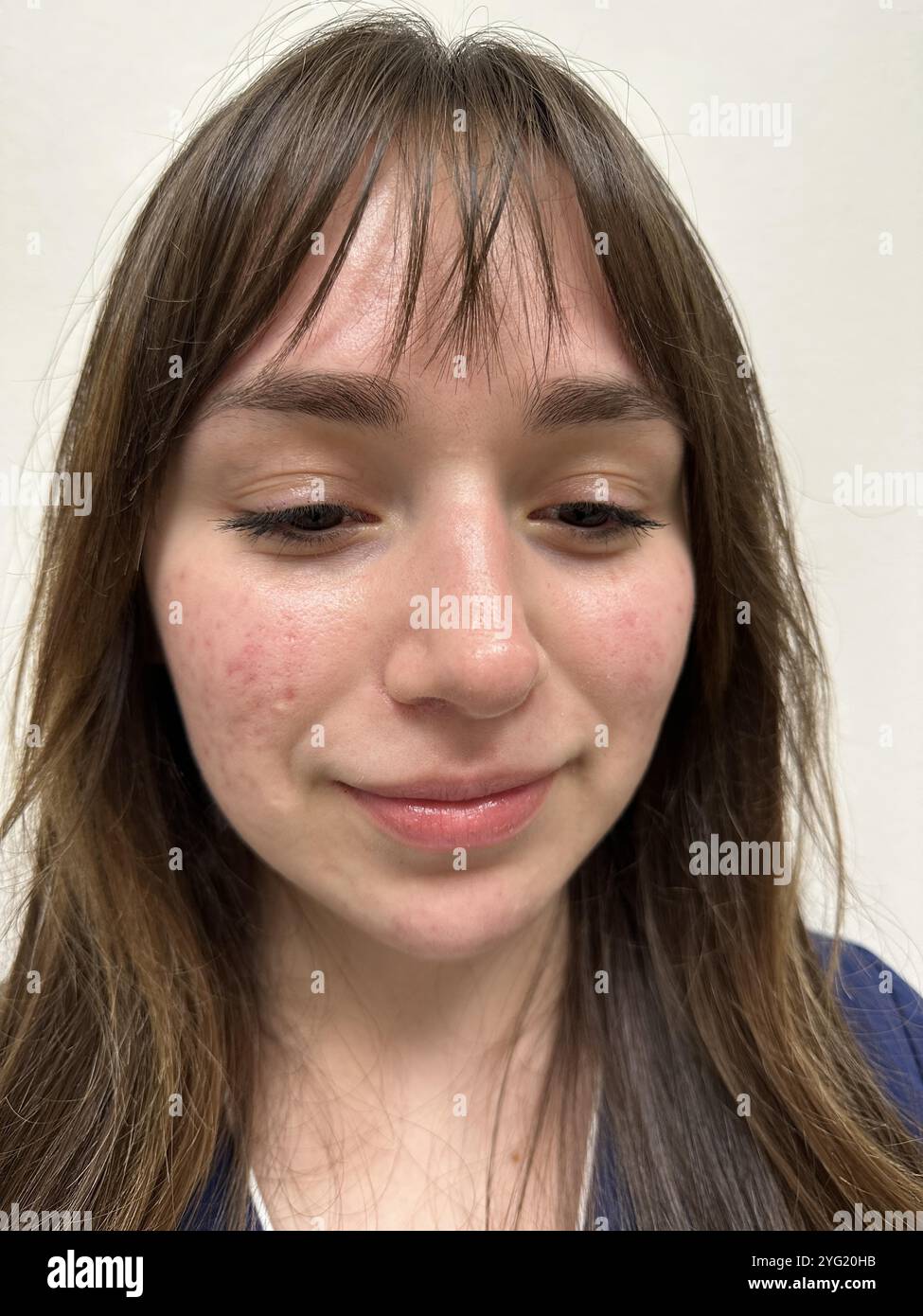 Editorial use only Face of female patient whose acne is improving due ...