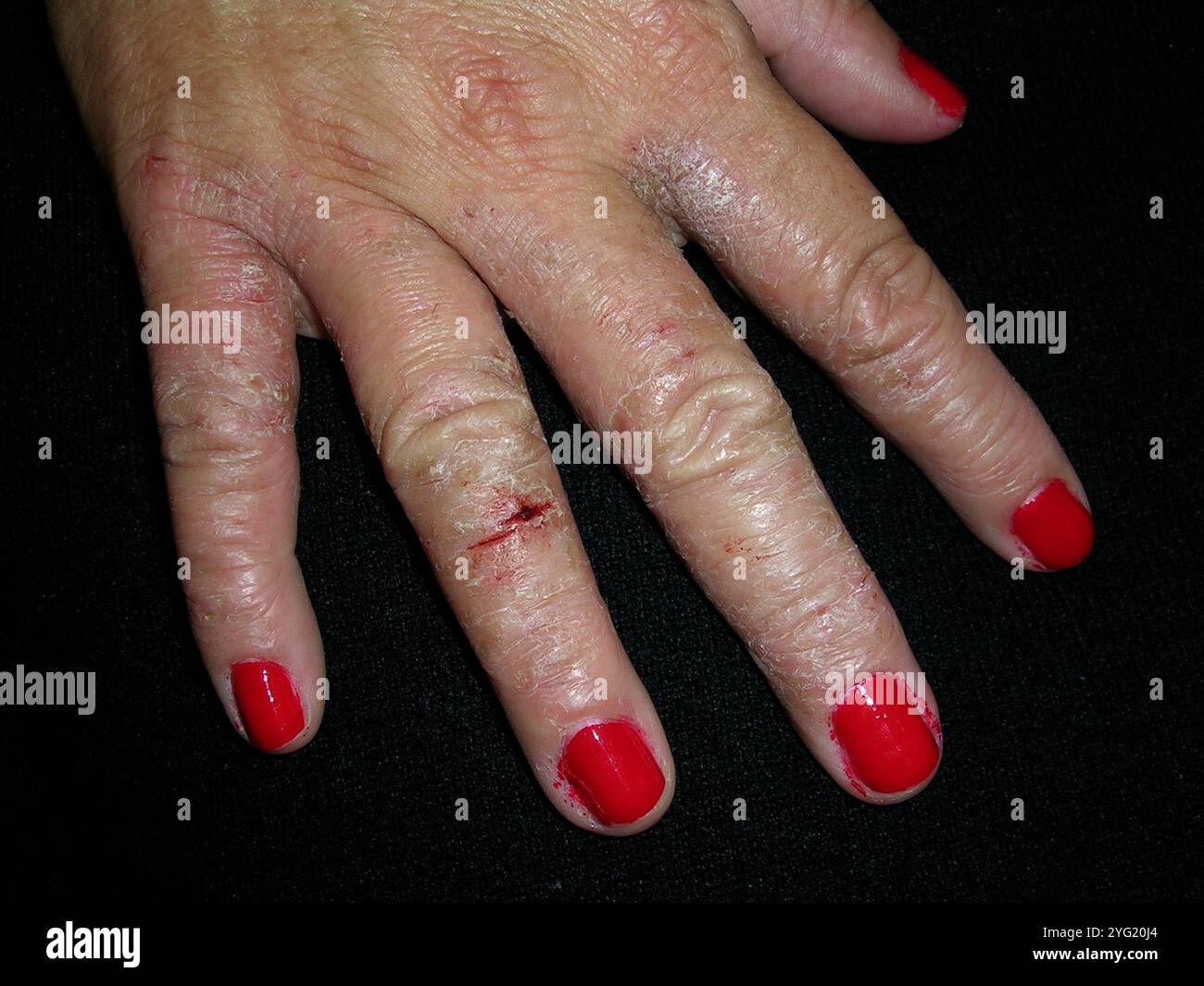 Bleeding cracked skin on the hand of a female patient with dermatitis ...