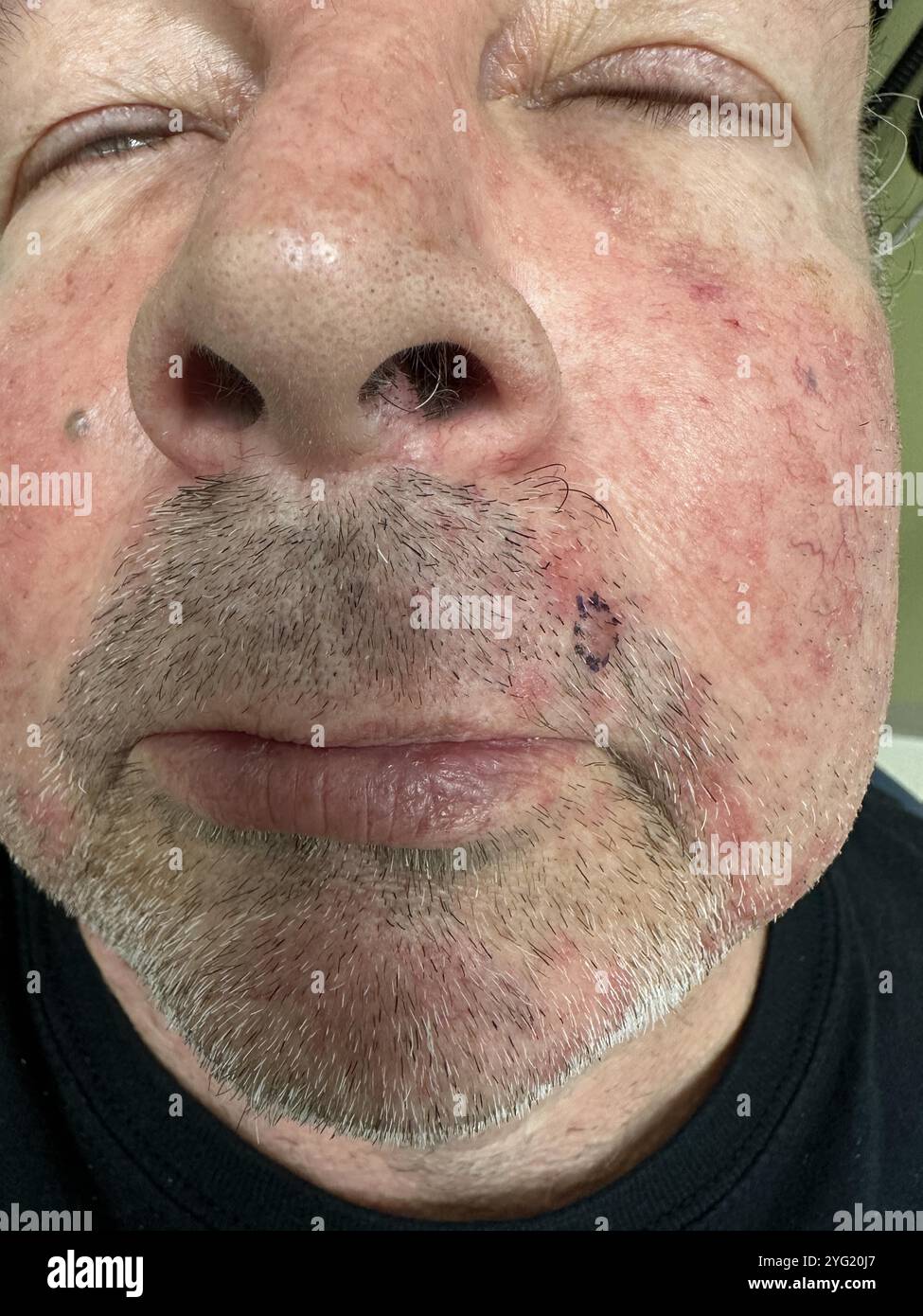 Editorial use only Basal cell carcinoma (BCC), or rodent ulcer, on a ...