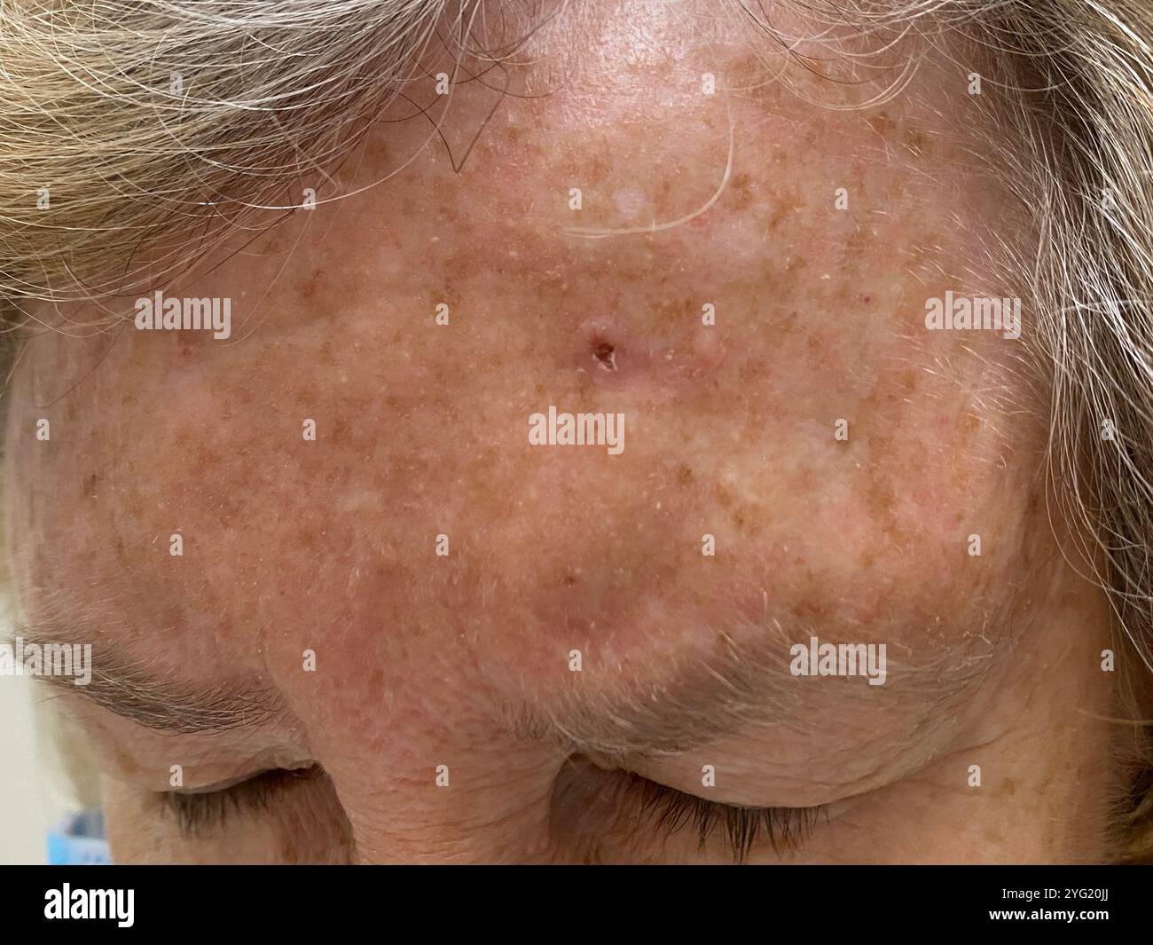Basal cell carcinoma (BCC), or rodent ulcer, on a patient's forehead ...