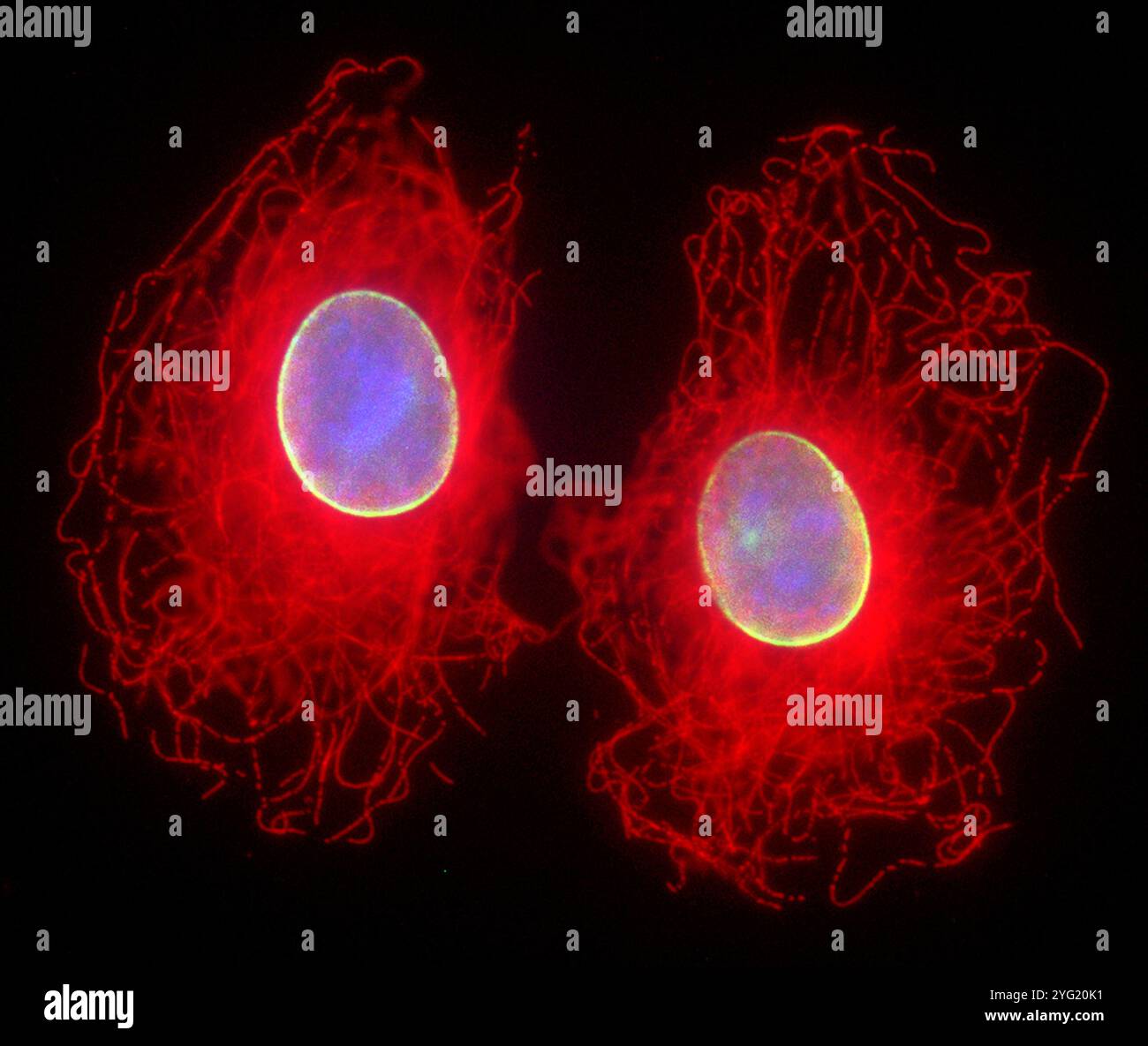 Fluorescent light micrograph of two cultured human cancer cells in ...
