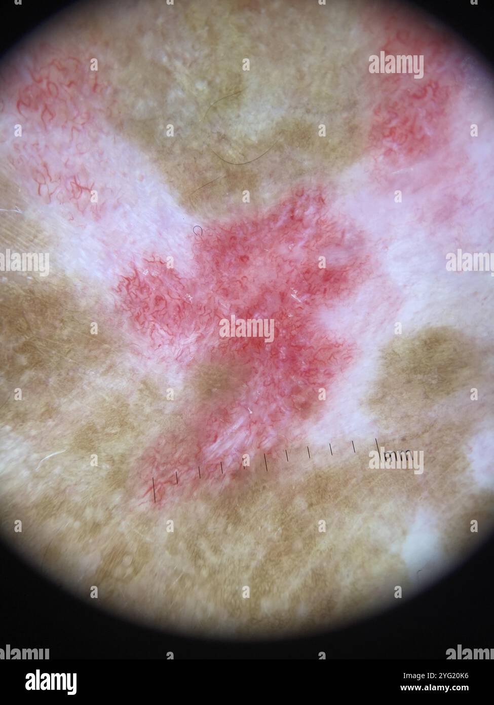 Dermatoscope image of lesions on the skin of a patient with severe ...