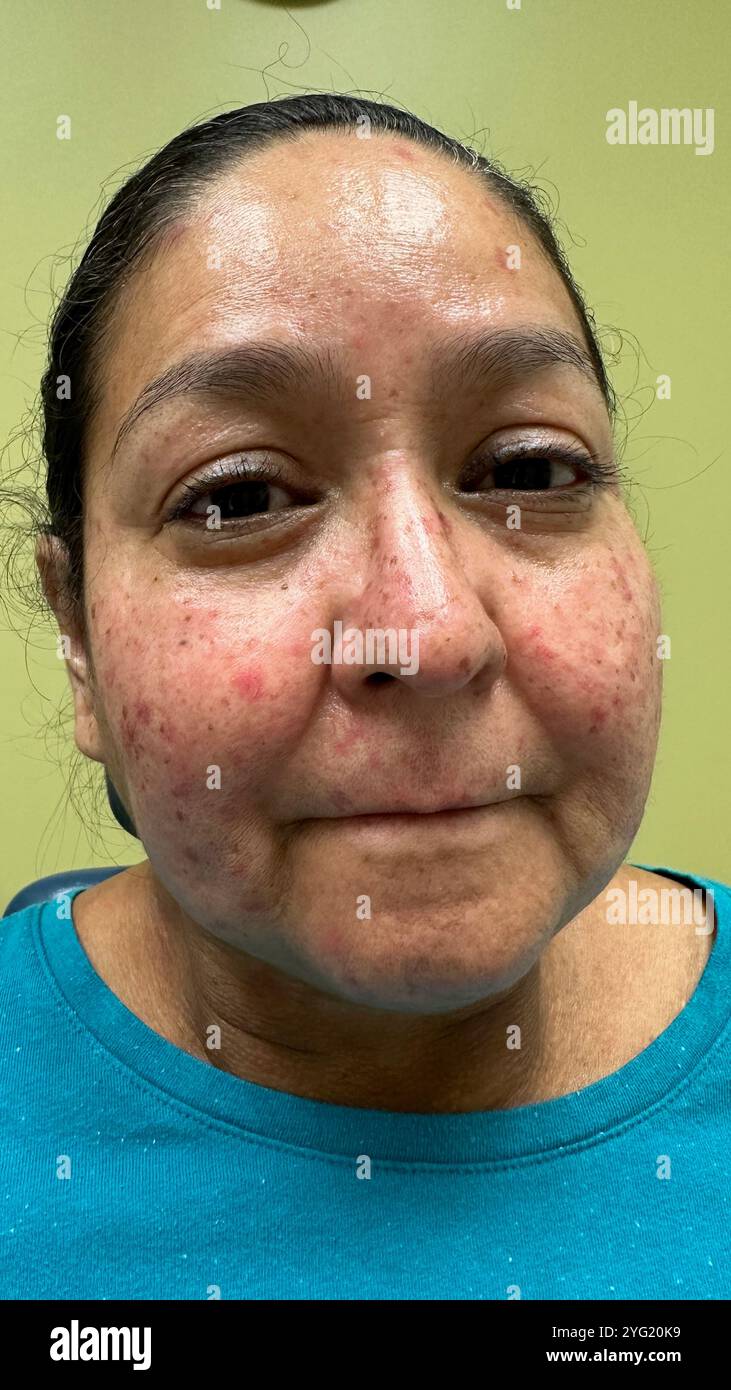 Editorial use only Patient with CREST syndrome. CREST is a form of ...