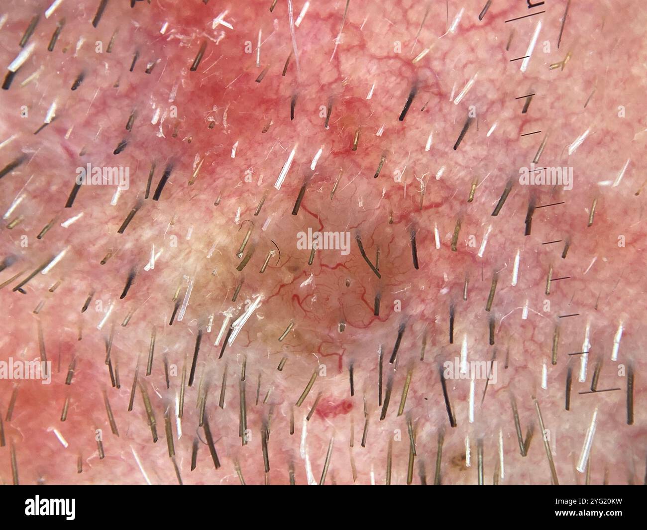 Dermatoscope image of a basal cell carcinoma (BCC), or rodent ulcer, on ...