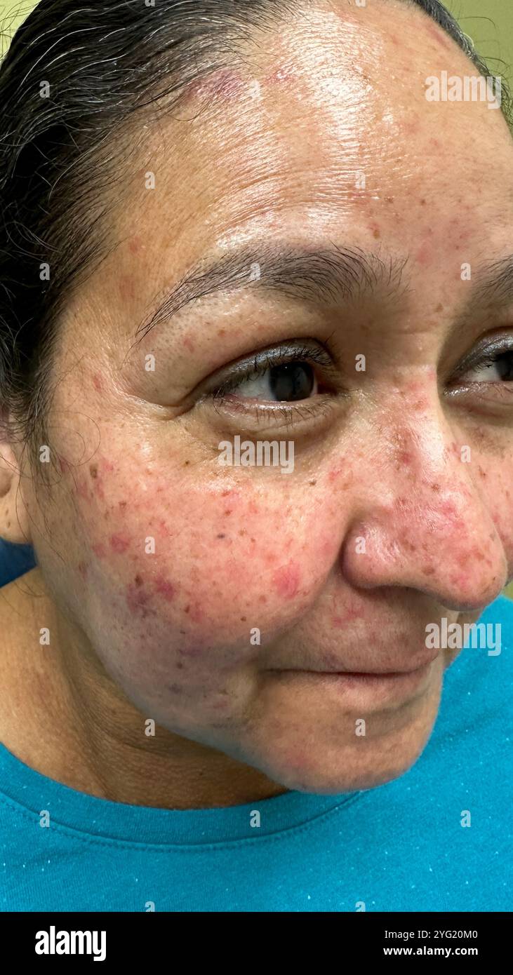 Editorial use only Patient with CREST syndrome. CREST is a form of ...