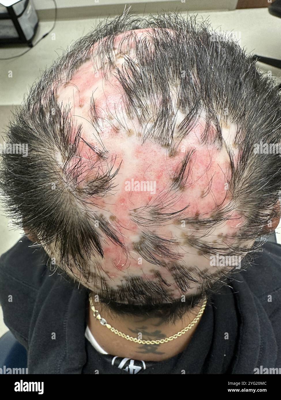 Lesions on the head of a patient with severe discoid lupus ...