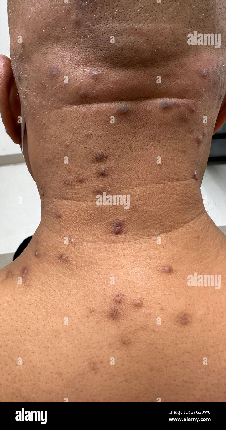 Nodular prurigo on a patient's neck. This condition is characterised by ...