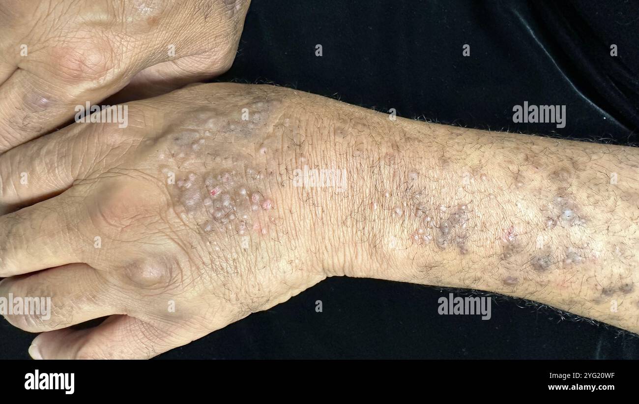 Nodular prurigo on a patient's arm and hand. This condition is ...