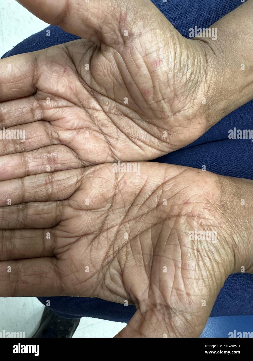 Scleroderma affecting a patient's hands. Scleroderma, also known as ...