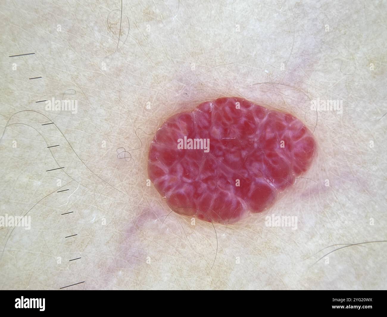 Dermatoscope image of a haemangioma on a patient's skin. Haemangiomas ...