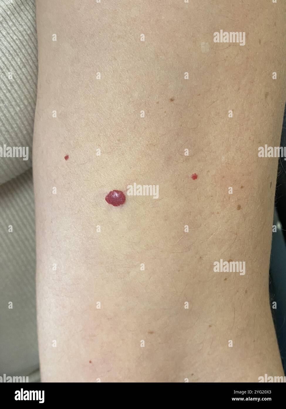 Haemangioma on a patient's arm. Haemangiomas (also called strawberry ...