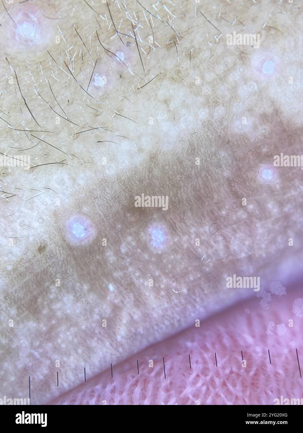 Dermatoscope image of papules on the lip of a patient with molluscum ...
