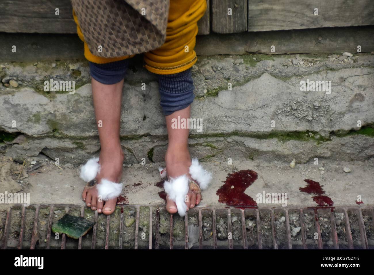 Bloodletting ancient medical practice hi-res stock photography and ...