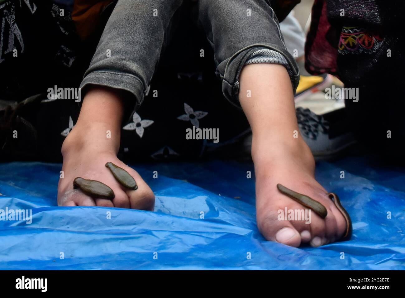 Skin conditions children hi-res stock photography and images - Alamy