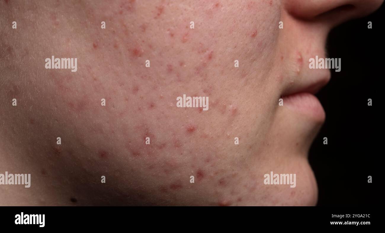 Skin treatment. Acne vulgaris, black spots and pimples. Girl with bad ...