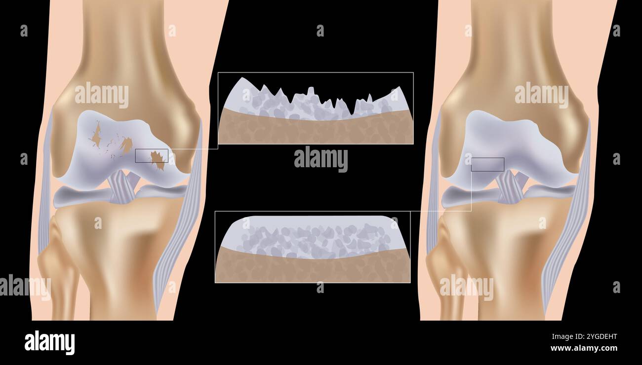 Knee arthritis. Medical vector illustration with damaged knee structure ...