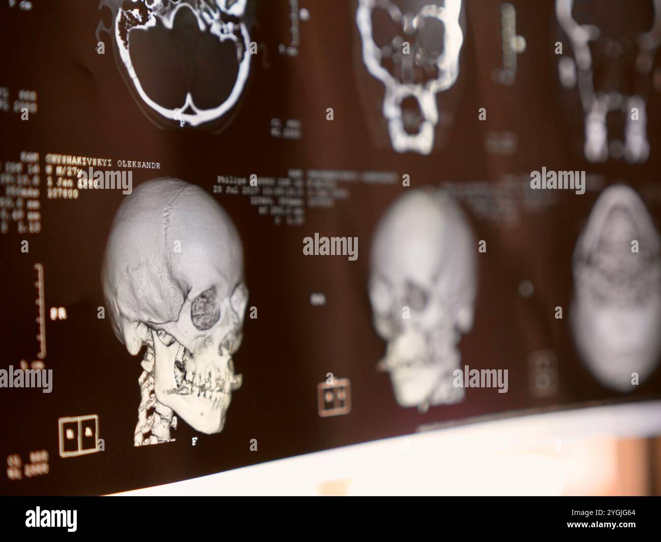 MRI of the human brain of a patient with multiple sclerosis of the ...