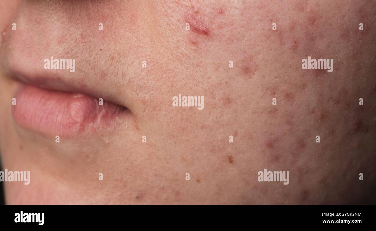 Skincare. Acne treatment. Face, skin, pimples. Girl with pimples ...