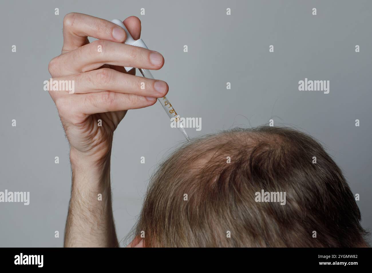 Hair loss problem. Man applying dropper with minoxidil or serum ...