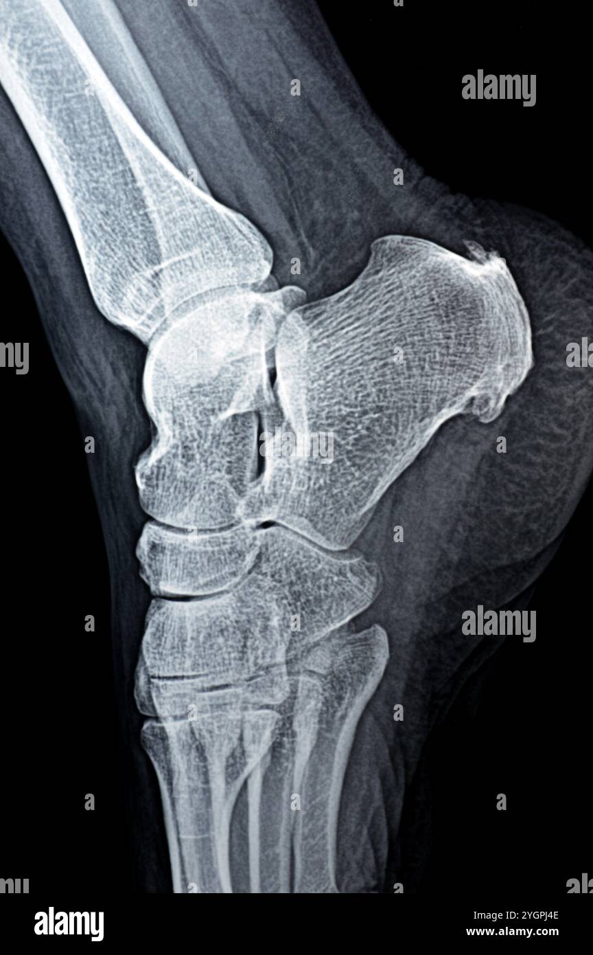 Plain X ray of female patient foot shows calcaneal heel spur, bony ...