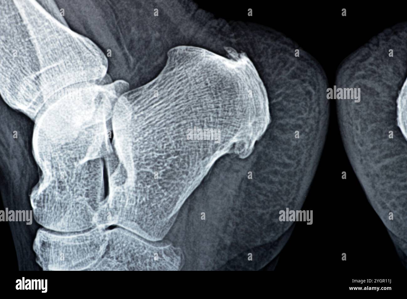 Plain X ray of female patient foot shows calcaneal heel spur, bony ...