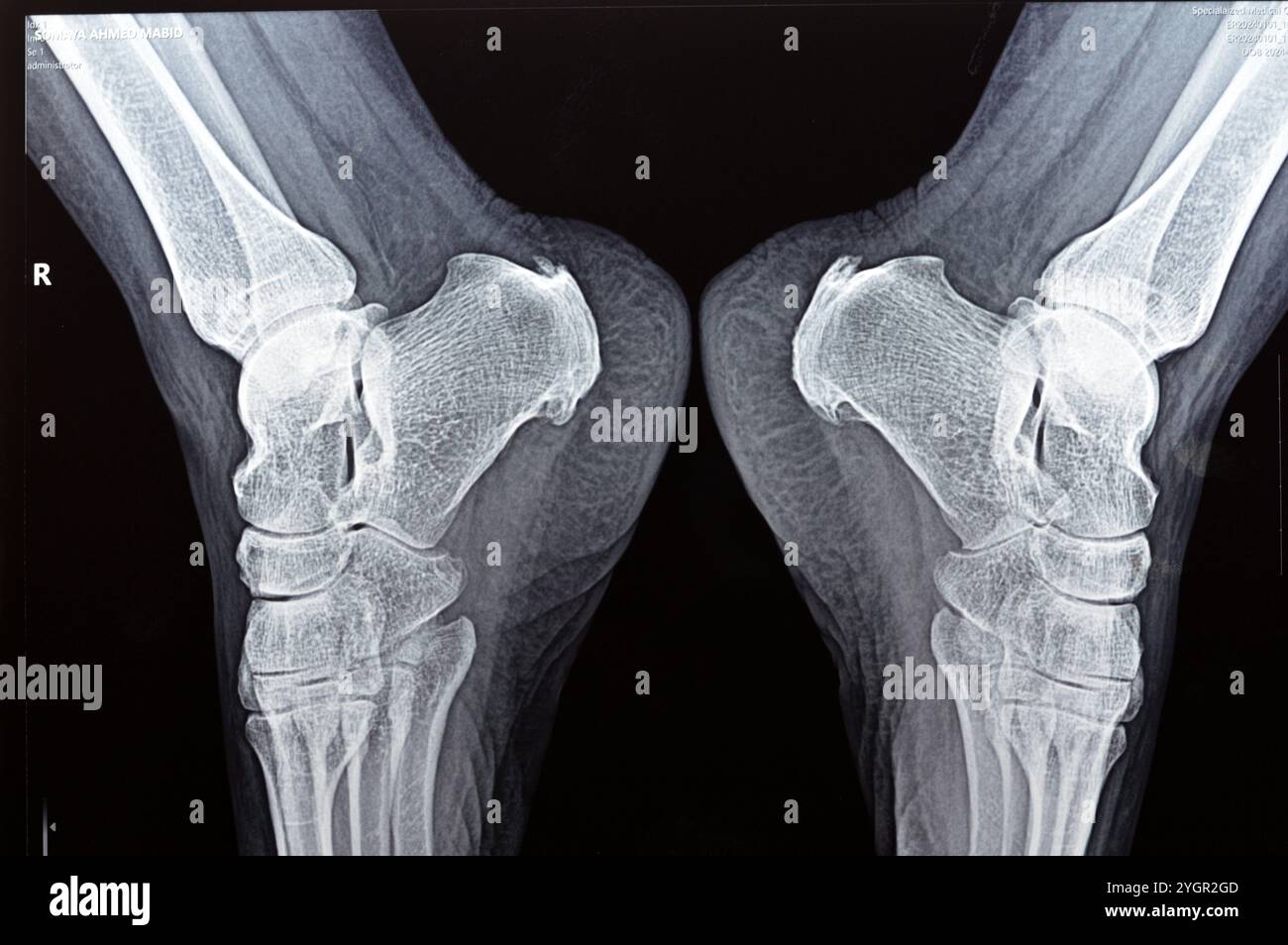 Plain X ray of female patient foot shows calcaneal heel spur, bony ...