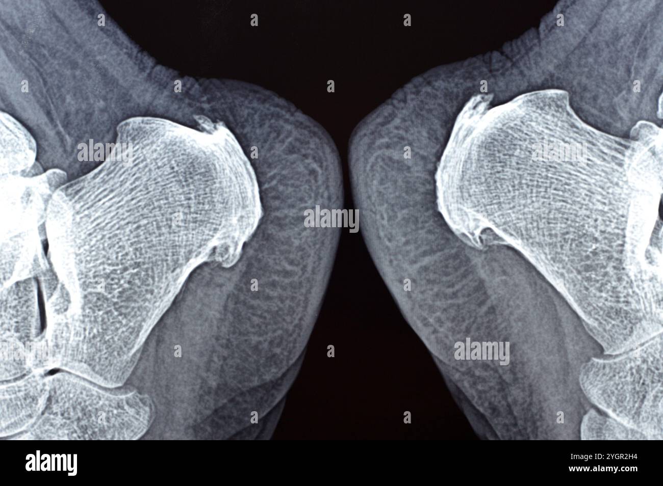 Plain X ray of female patient foot shows calcaneal heel spur, bony ...