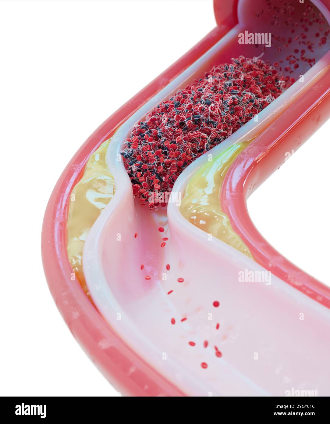 Illustration of a blood vessel with atherosclerosis and a blood clot ...