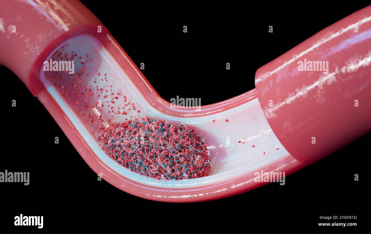 Illustration of a blood clot (thrombus) in a blood vessel. Clots are ...