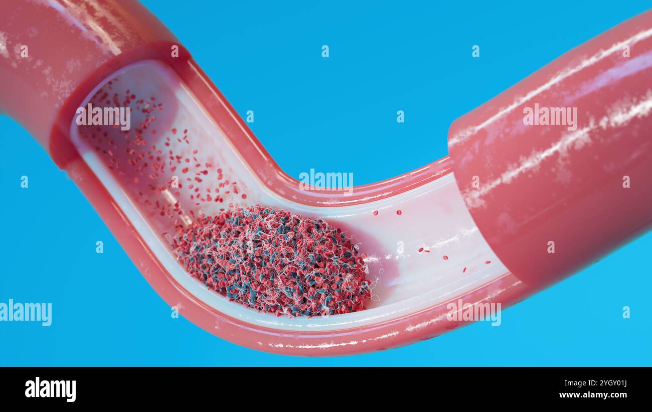 Illustration of a blood clot (thrombus) in a blood vessel. Clots are ...