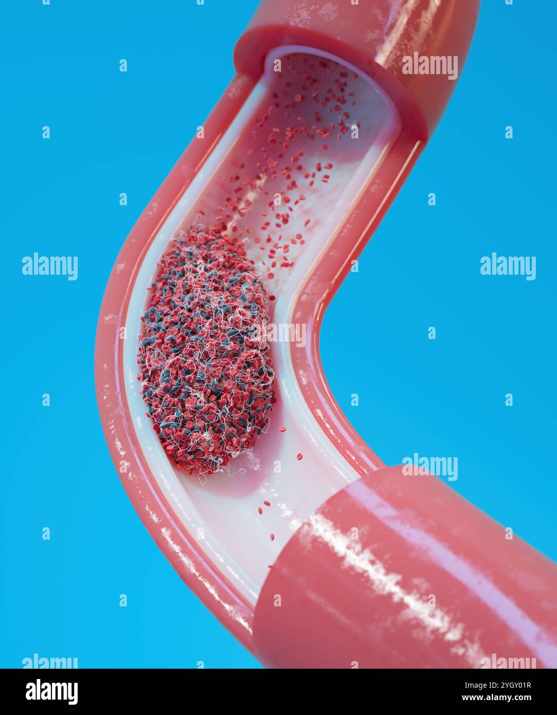 Illustration of a blood clot (thrombus) in a blood vessel. Clots are ...