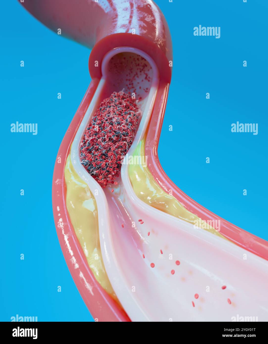 Illustration of a blood vessel with atherosclerosis and a blood clot ...