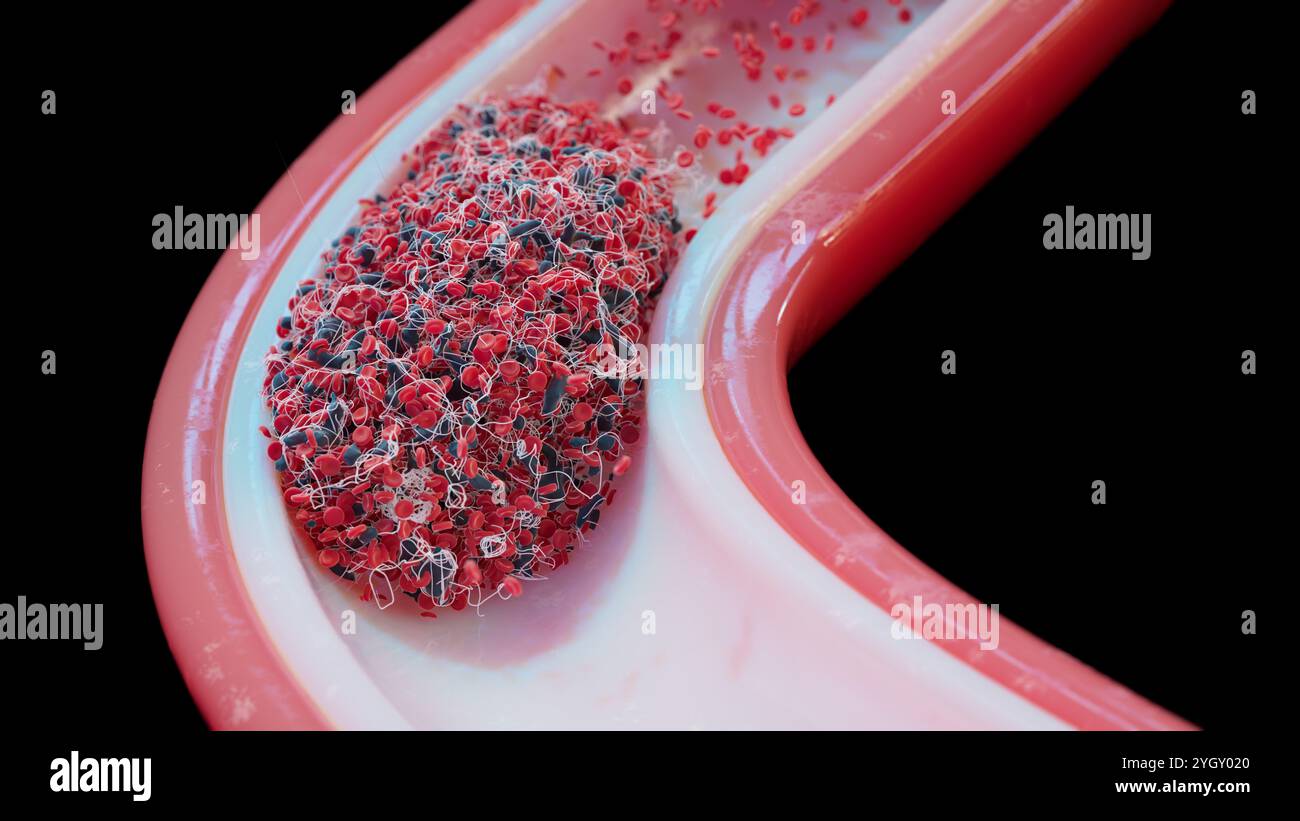 Illustration of a blood clot (thrombus) in a blood vessel. Clots are ...