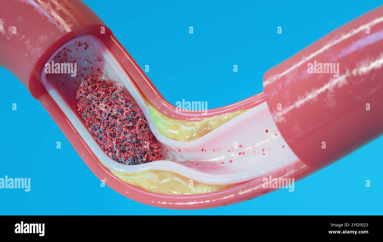 Illustration of a blood vessel with atherosclerosis and a blood clot ...