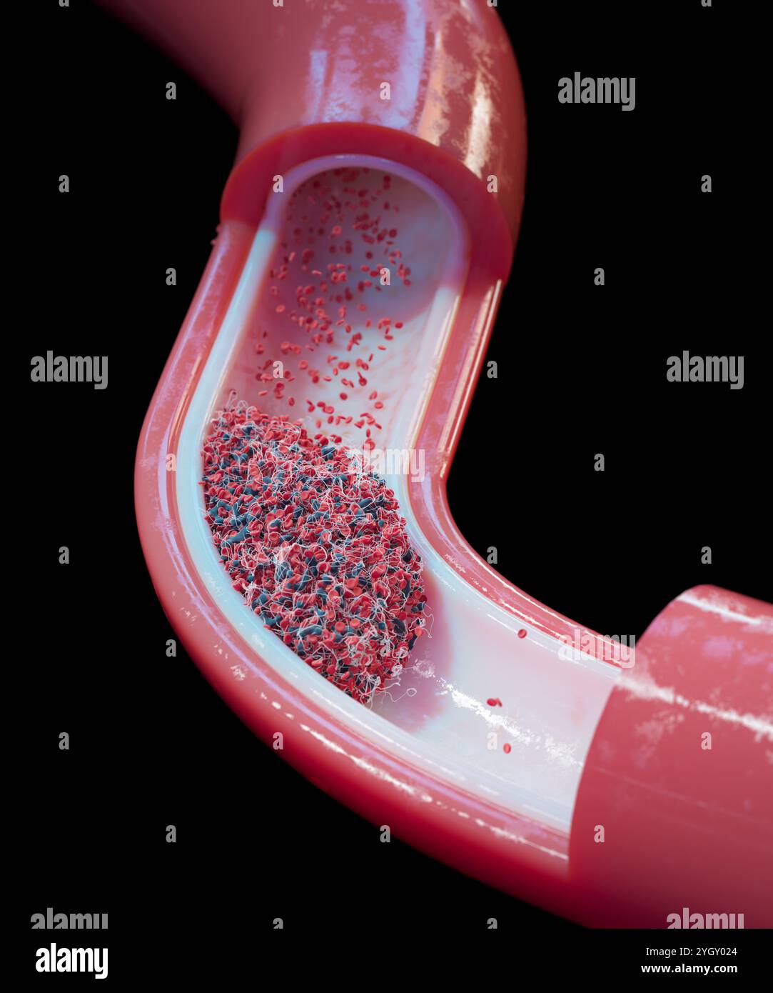 Illustration of a blood clot (thrombus) in a blood vessel. Clots are ...