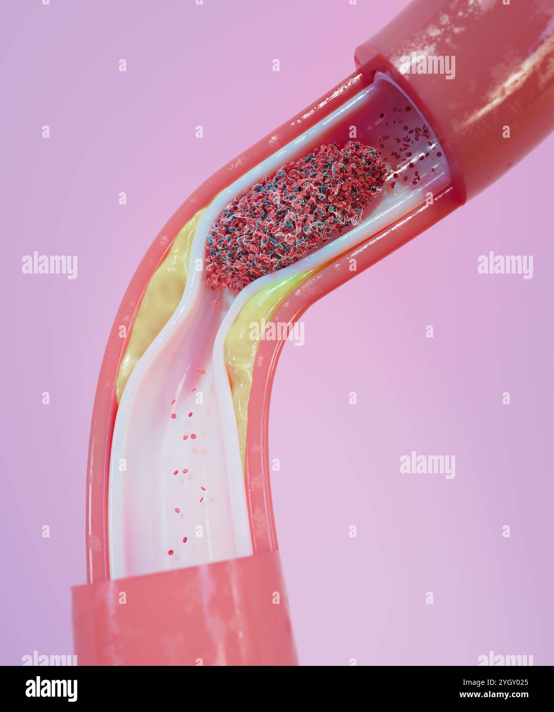 Illustration of a blood vessel with atherosclerosis and a blood clot ...