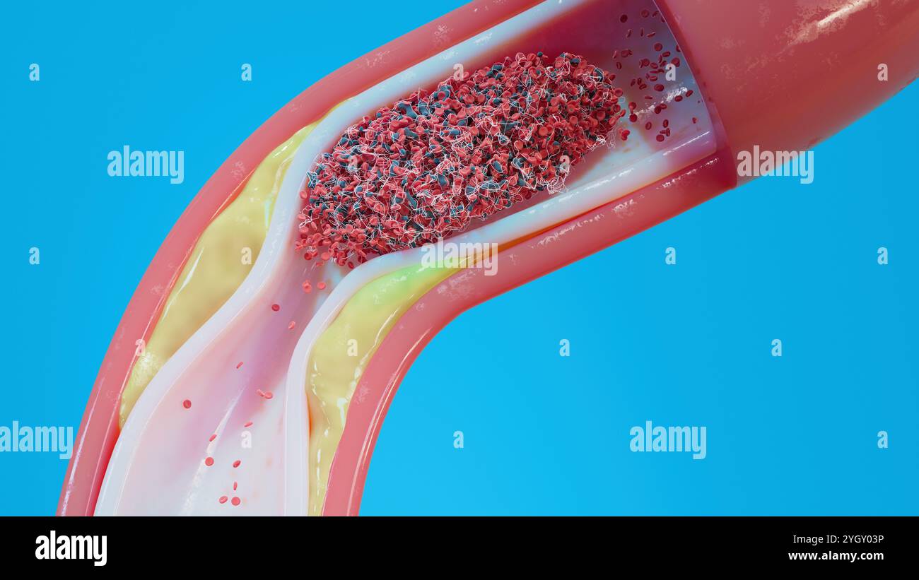 Illustration of a blood vessel with atherosclerosis and a blood clot ...