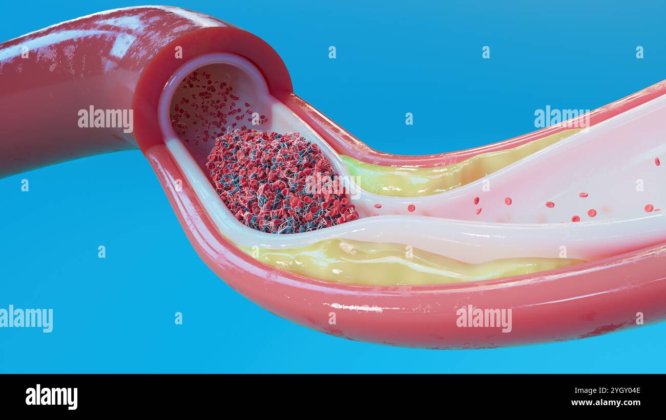 Illustration of a blood vessel with atherosclerosis and a blood clot ...