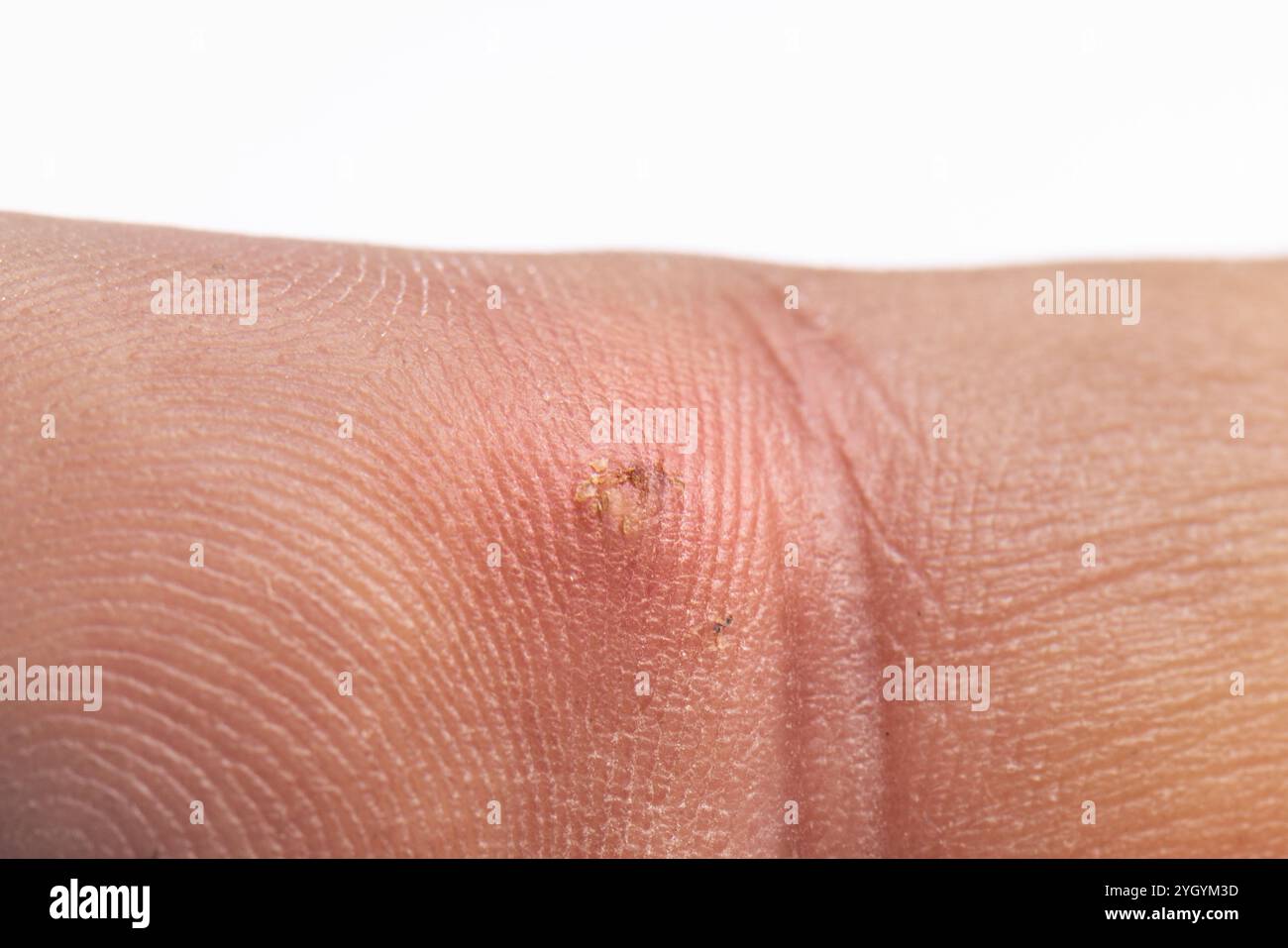 Finger bacteria infection hi-res stock photography and images - Alamy