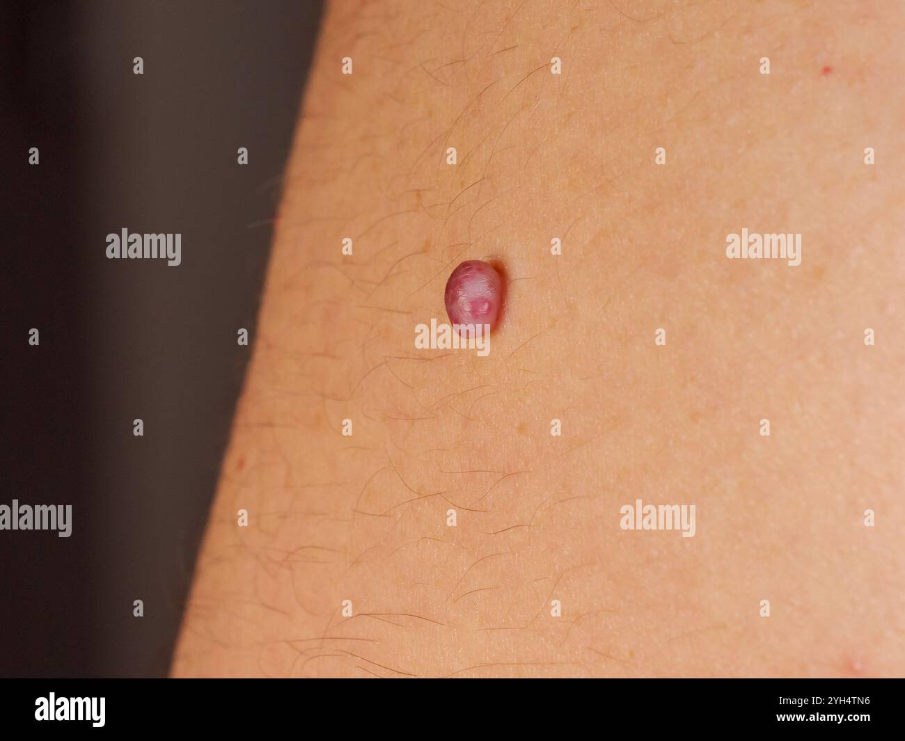 Mole – a soft, pigmented mole protruding above the skin surface, close ...