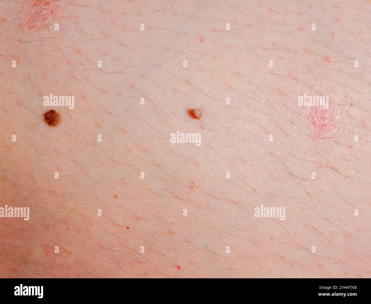 Mole – a soft, pigmented mole protruding above the skin surface, close ...