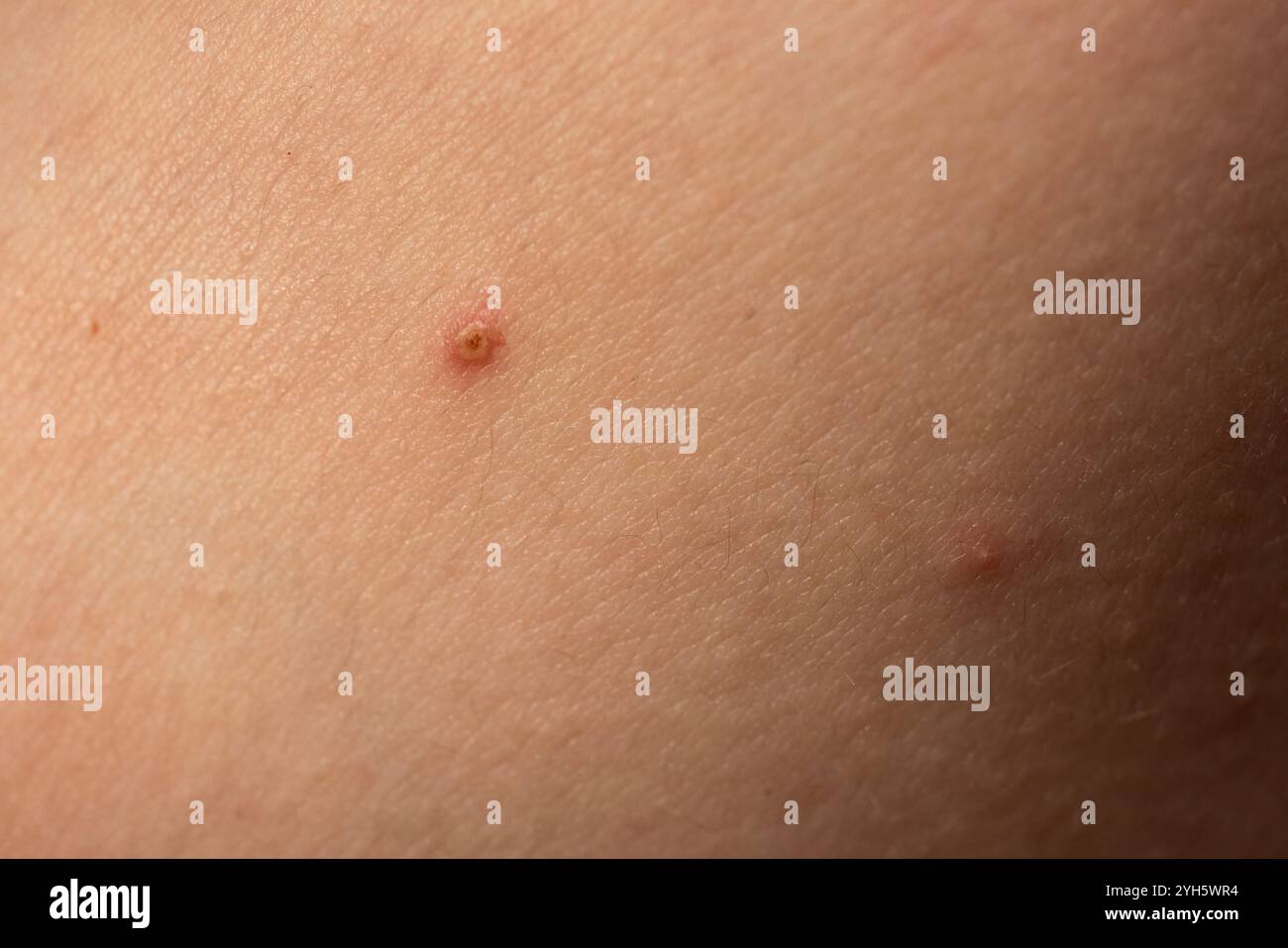 Dermatology skincare. Puberty woman. Pimples problem. Skin texture ...
