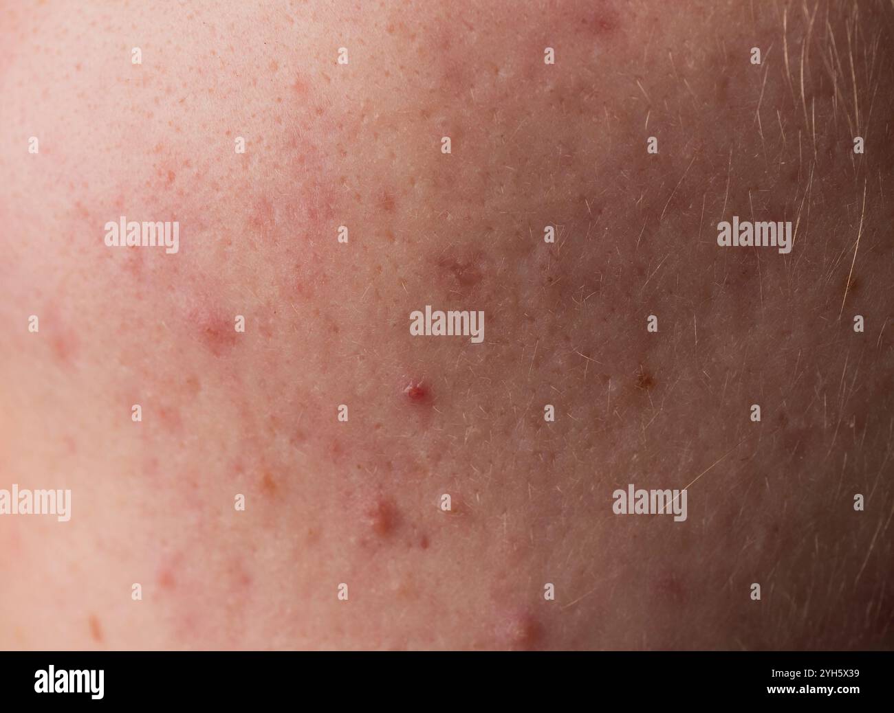 Many pimples. Bad skin. Hormonal acne, puberty. Skin acne background ...