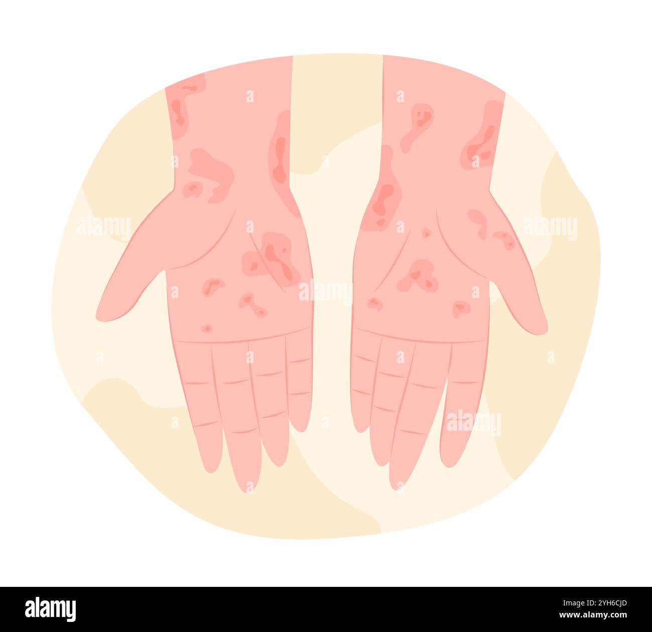 Eczema or Skin Rashes on Human Hands for Dermatology Concept Illustration Stock Vector Image ...