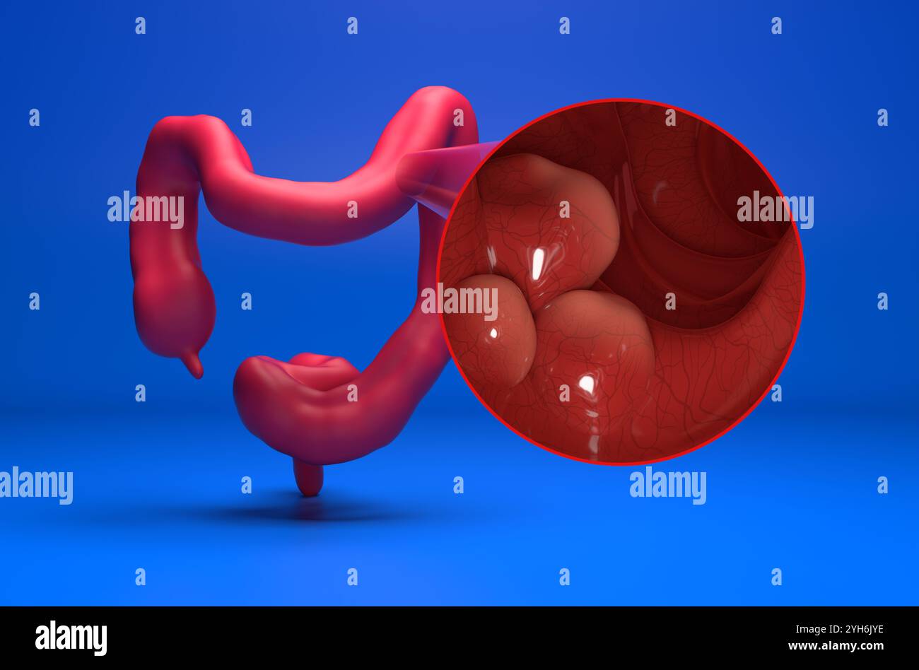 Colitis ulcerosa illustration hi-res stock photography and images - Alamy