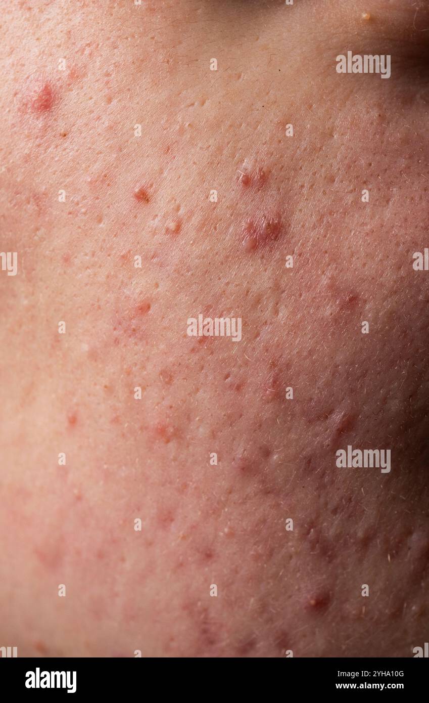Dermatological acne. Skin texture background. Closeup acne pimple ...