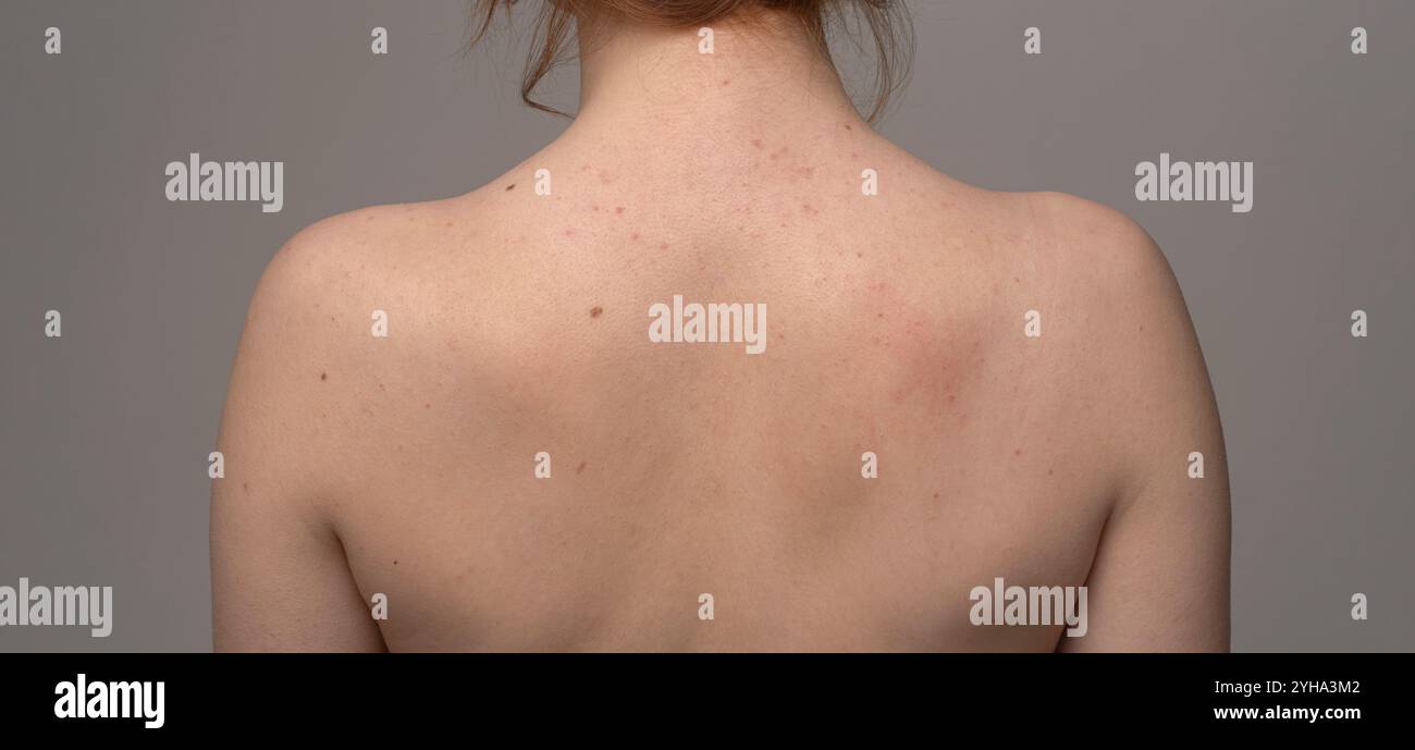 Skin texture background. Acne pimple on back. Treatment for skin ...