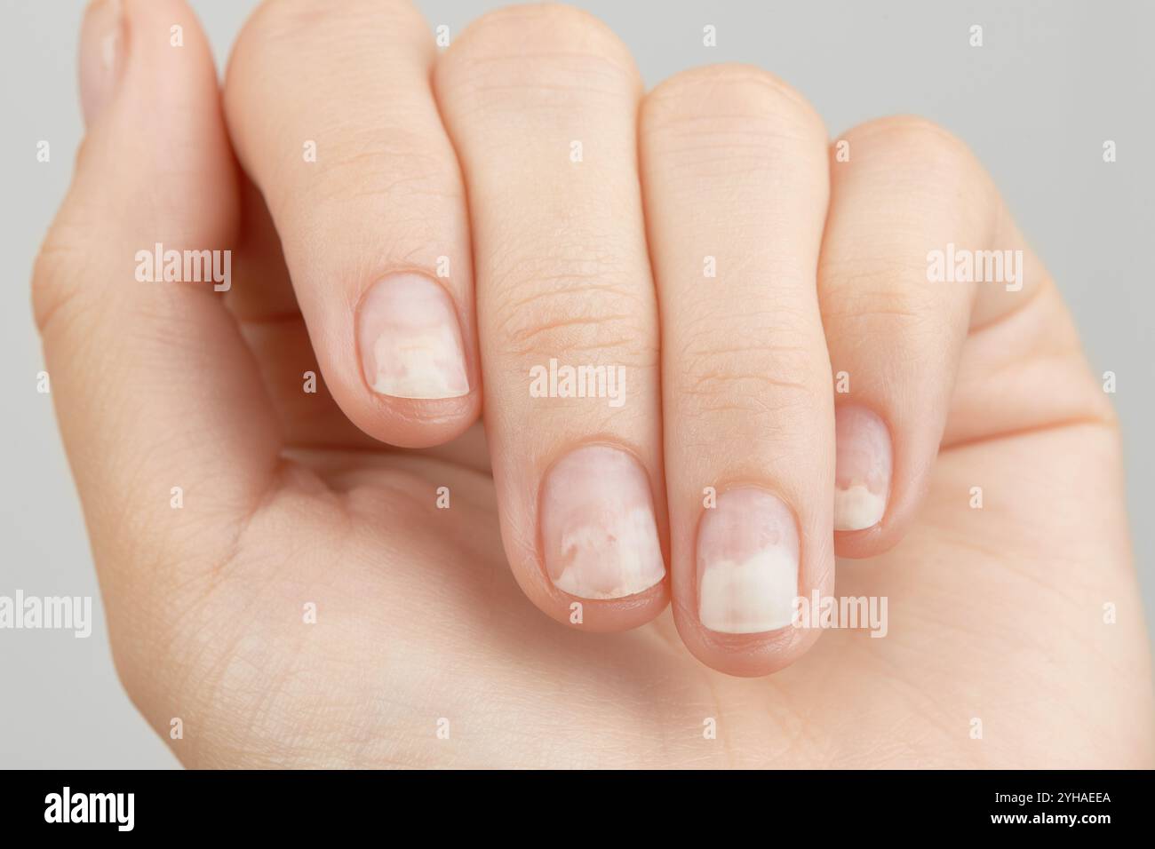 Fingernails with onycholysis after removing gel polish. Womans hands ...