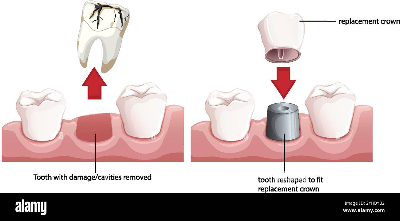 Illustration showing steps for dental crown replacement Stock Vector ...
